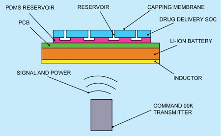 Implantable Drug Delivery System