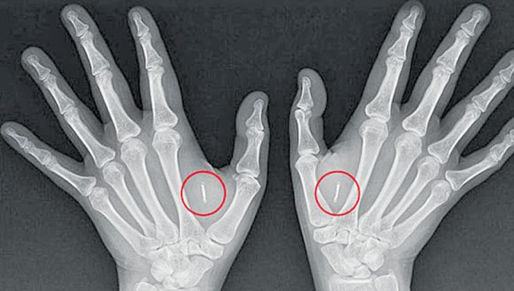 Microchip Implants: Are You Ready For Them? | Must Read