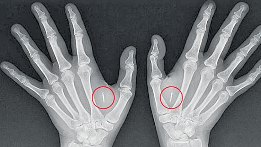 Microchip Implants: Are You Ready For Them? | Must Read
