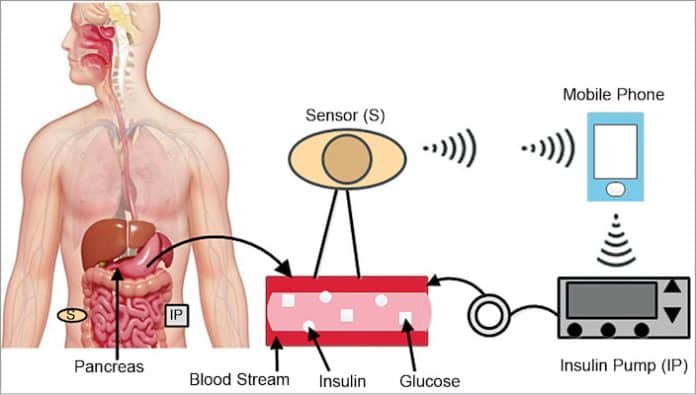 Artificial Pancreas: An Engineering Revolution In Healthcare