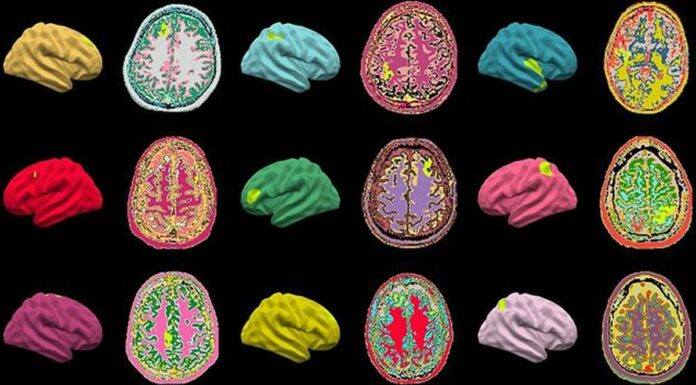 AI to Detect and Identify Brain Defects