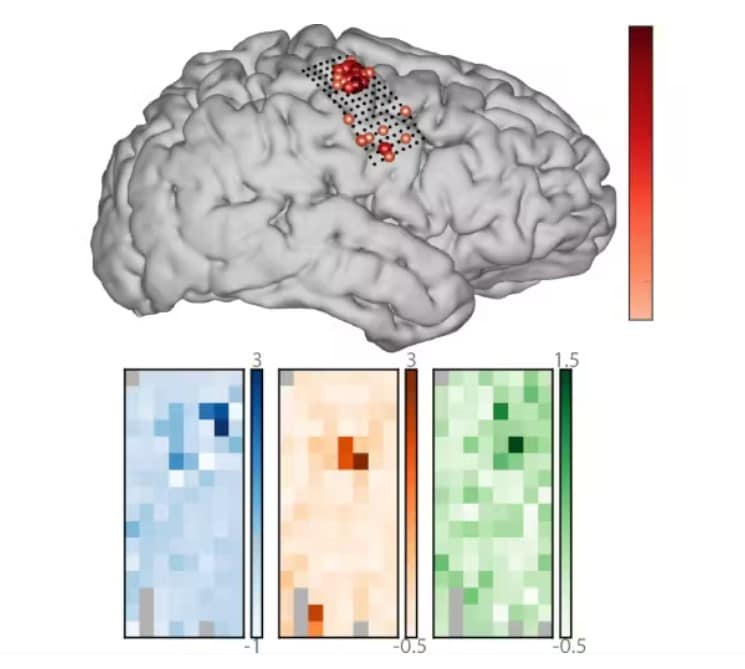Brain Implants Transformed Thoughts Into Speech